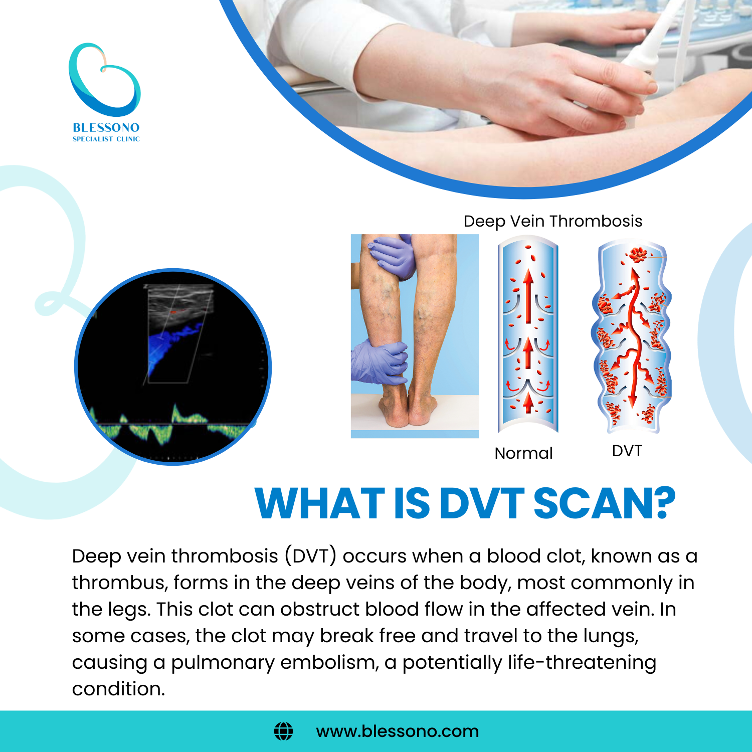 What is Deep Vein Thrombosis (DVT Scan)